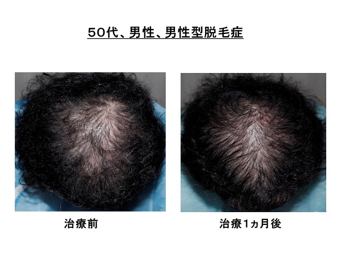 抗ヒスタミン剤ルパフィンで脱毛した患者様、治療1ヵ月で改善！ 患者様からの声・メディア掲載・クリニックからのお知らせ 名古屋kクリニック